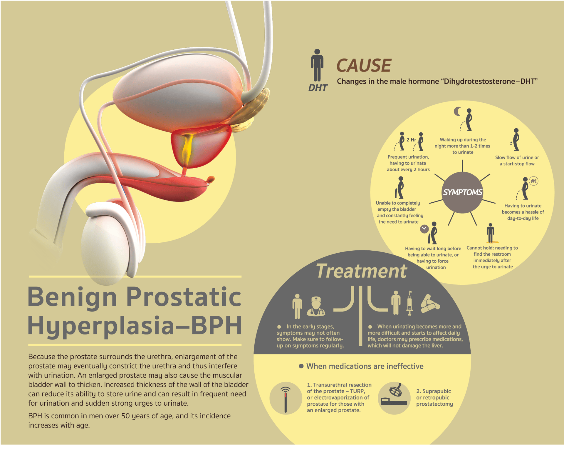 Get to know BPH (Benign Prostatic Hyperplasia) | Bumrungrad